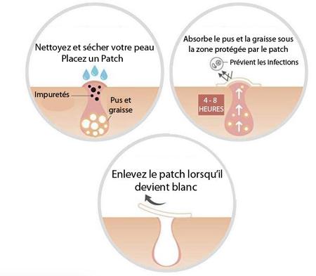 Patchs contre Boutons et Acné BREYLEE™ – O MyBeauty